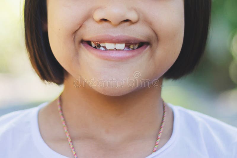 Asian kid`s decayed teeth stock image. Image of people - 103902837