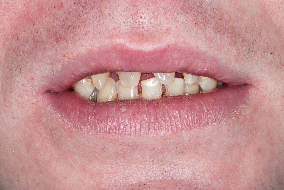 Decayed teeth stock photo. Image of poor, health, decayed - 171661498