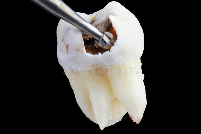 Decayed tooth stock image. Image of coronal, decayed - 27885603