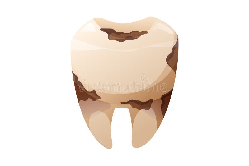 Decayed Tooth with Cavities and Plaque Buildup. Damaged Molar Vector ...