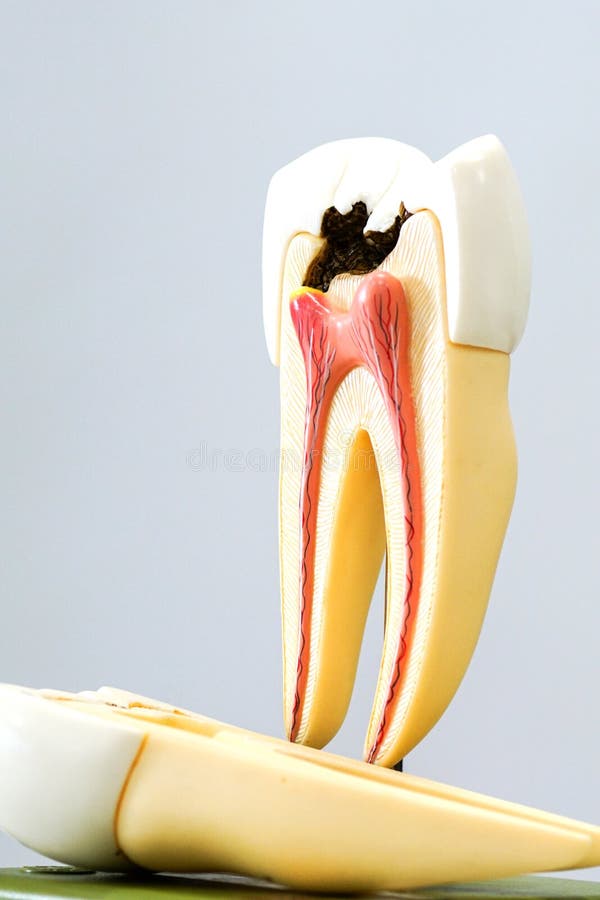 Decayed tooth model stock photo. Image of miniature, clean - 97323446