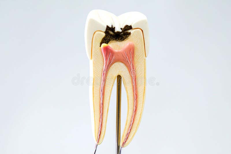 Decayed tooth model stock image. Image of medical, enamel - 97323441