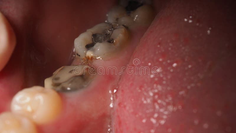 Decayed Tooth Root Canal Treatment. Tooth or Teeth Decay of Lower Molar ...