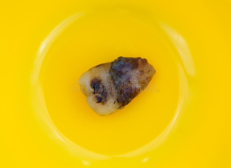 Decayed Wisdom Tooth at the Bottom of a Bowl Stock Image - Image of ...