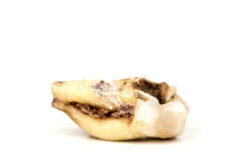 Decayed wisdom tooth stock photo. Image of teeth, background - 140222128