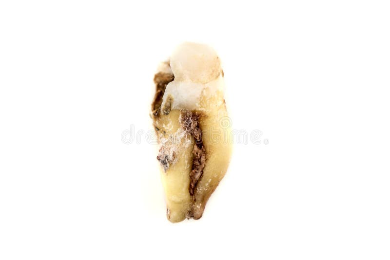Decayed wisdom tooth stock image. Image of medicine - 140222319
