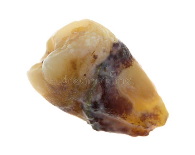 2,953 Wisdom Tooth Stock Photos - Free & Royalty-Free Stock Photos from ...