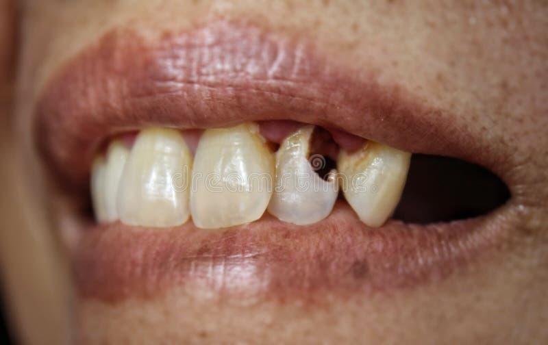 Decaying maxillary teeth stock image. Image of care - 263781563
