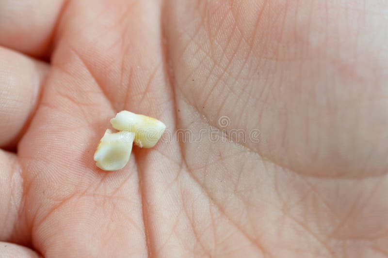 Deciduous Primary Baby Temporary Teeth, the First Set of Teeth in the ...