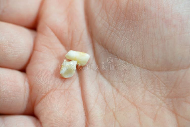 Deciduous Teeth Set Stock Photos - Free & Royalty-Free Stock Photos ...