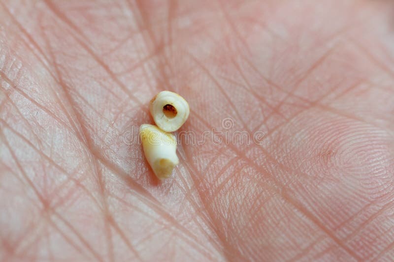Deciduous Primary Baby Temporary Teeth, the First Set of Teeth in the ...