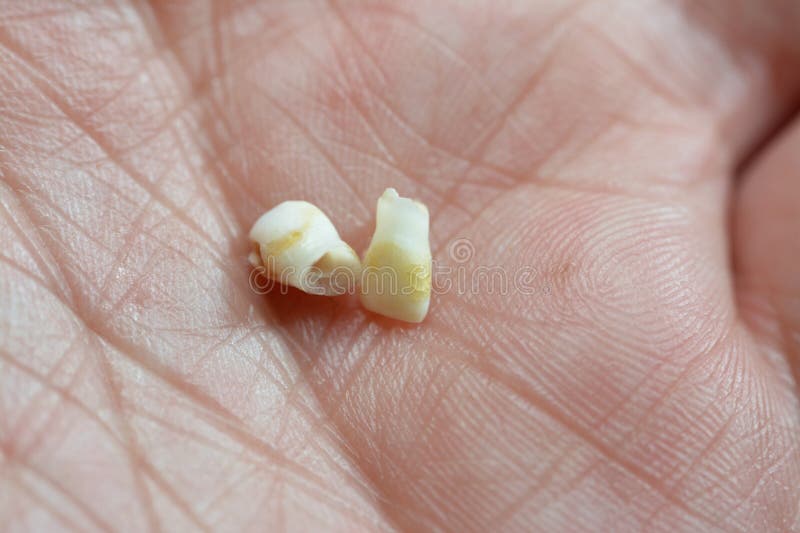 Deciduous Teeth Set Stock Photos - Free & Royalty-Free Stock Photos ...