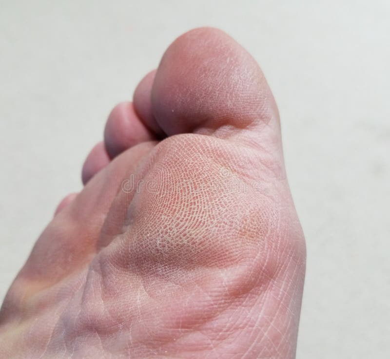 Dedos Del Pie Y Bola Secos Y Escamosos Del Pie Imagen de archivo ...