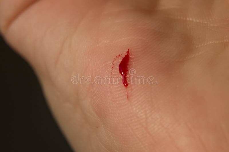 Deep Cut Caused by Knife in Hand Palm Stock Image - Image of finger ...