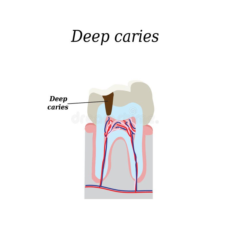 Deep Tooth Decay. Vector Illustration on Stock Vector - Illustration of ...