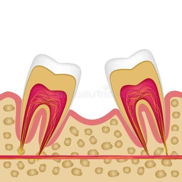 Defect Missing Tooth Stock Illustrations – 13 Defect Missing Tooth ...