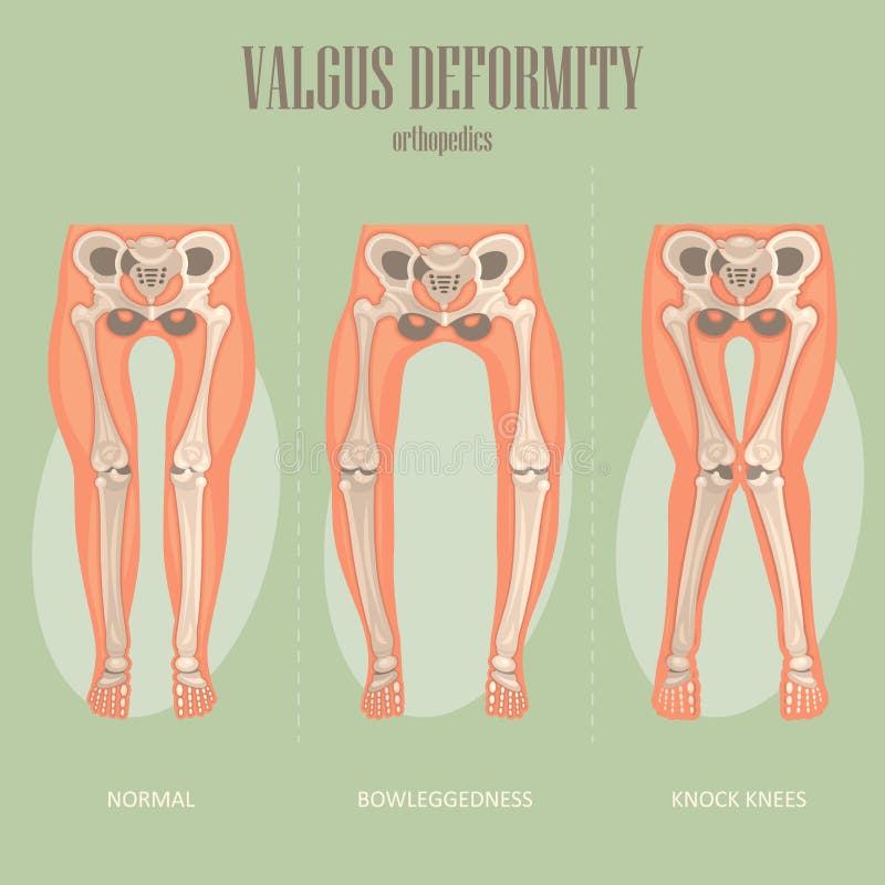 Pie Normal Y Varus De Hallux Ilustración del Vector - Ilustración de ...