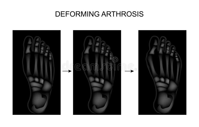 Deforming Arthrosis of the Foot Stock Vector - Illustration of body ...
