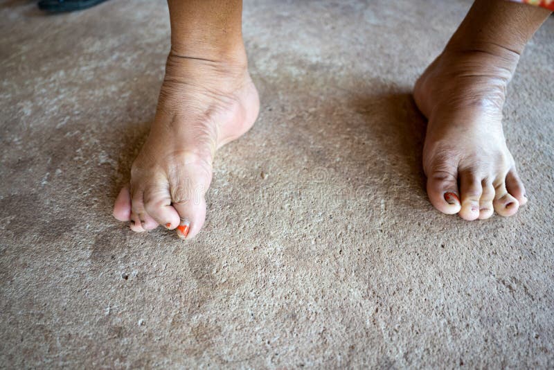 Deformity Right Foot by Poliomyelitis Stock Image - Image of health ...