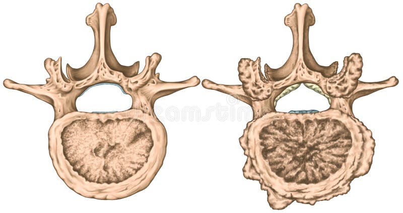 Advanced Uncovertebral Arthrosis of the Second Lumbar Vertebra Stock ...