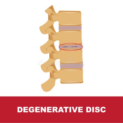Herniated Disc Stock Illustrations – 1,103 Herniated Disc Stock ...