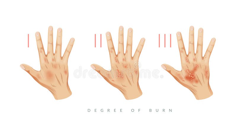 Third Degree Burn Stock Illustrations – 58 Third Degree Burn Stock ...