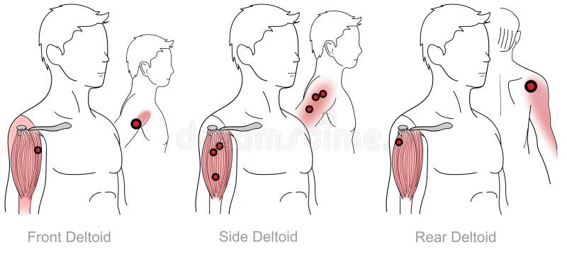 Deltoids Pain Cause by Myofascial Triggger Points. Stock Illustration ...