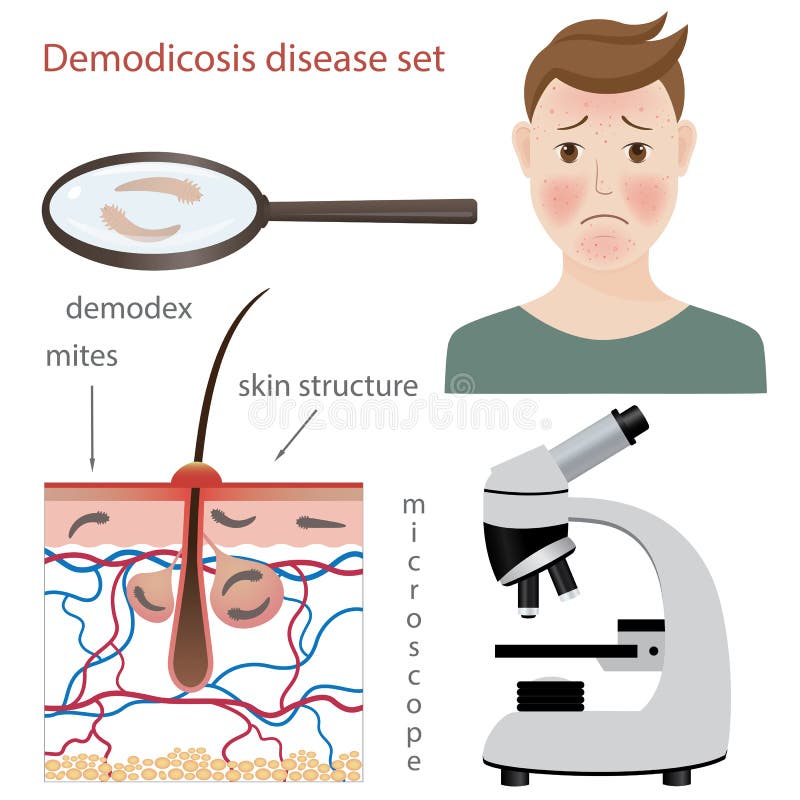 Demodicosis Di Stock Illustrations – 1 Demodicosis Di Stock ...