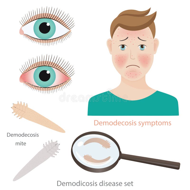 Demodicosis Demodex Mite Stock Illustrations – 23 Demodicosis Demodex ...