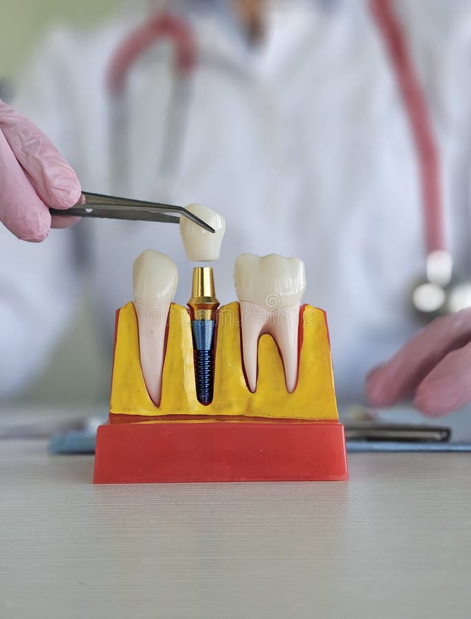Demonstration of Dental Implant Procedure with Models and Tools Stock ...