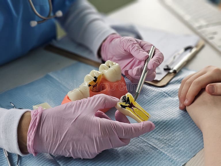 Demonstration of a Dental Procedure Using a Model of Teeth with Caries ...
