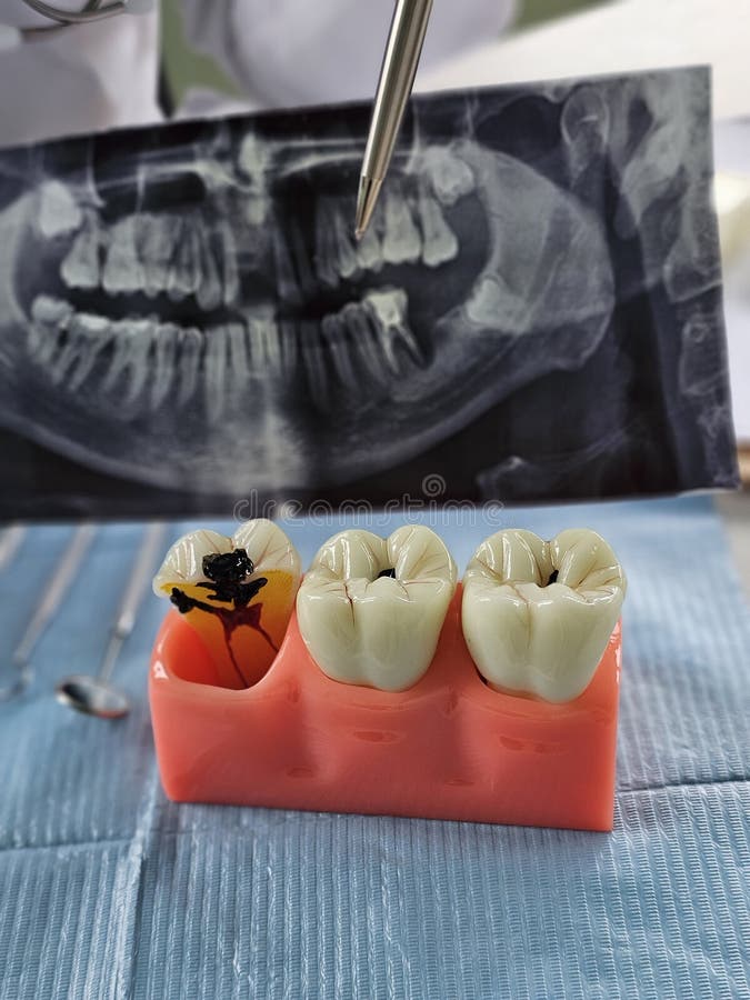 Demonstration of Dental Procedure Using Model Teeth and X-ray Stock ...