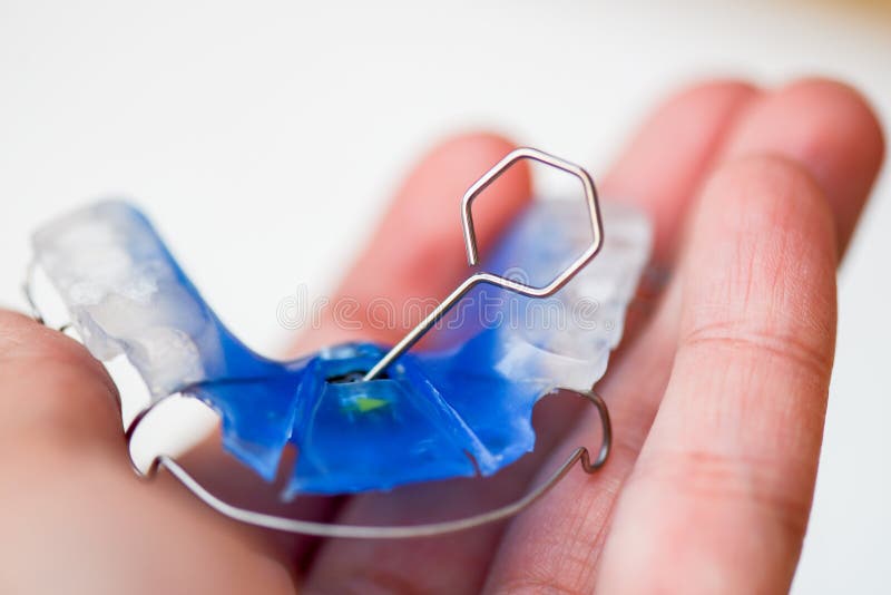 Dental Blue Removable Brace or Retainer for Teeth, Orthodontic Stock ...