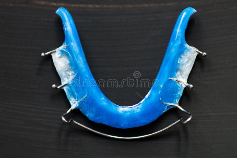Dental Blue Removable Brace or Retainer for Teeth, Orthodontic Stock ...