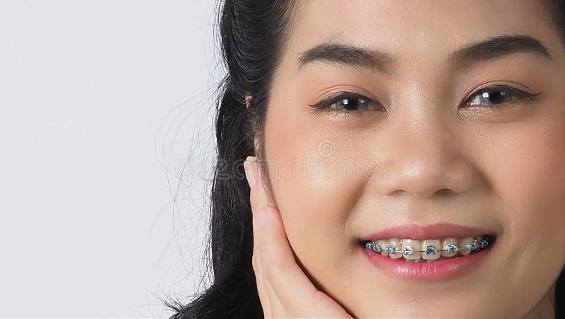 Dental Brace Teen Girl Smiling Looking On A Camera Stock Image Image