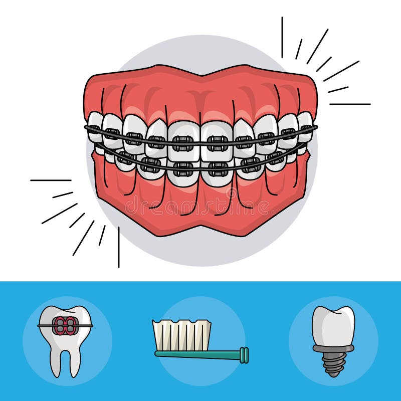 Dental braces elements stock vector. Illustration of patient - 127844714