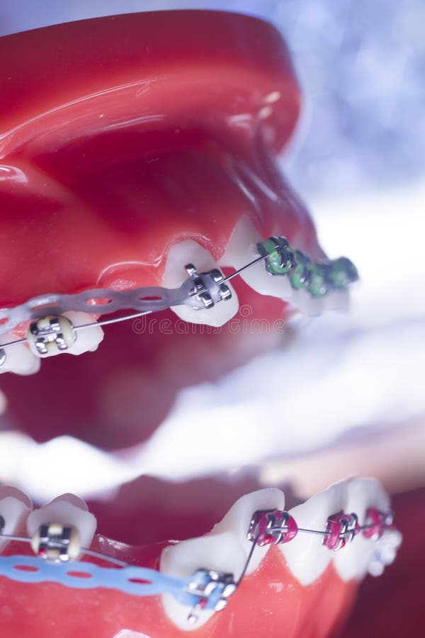 Dental Brackets Teeth Straighteners Stock Photo - Image of brackets ...