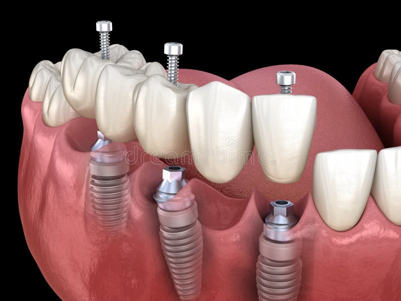 Dental Bridge of 3 Teeth Over Molar and Premolar. Medically Accurate 3D ...