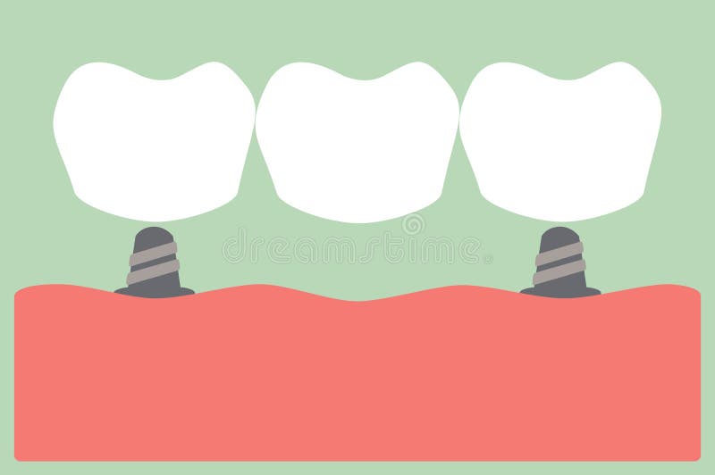 Dental bridge stock vector. Illustration of health, cartoon - 72376391
