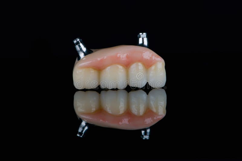 Dental Bridge Four Teeth and Artificial Gum Made of Monolithic ...