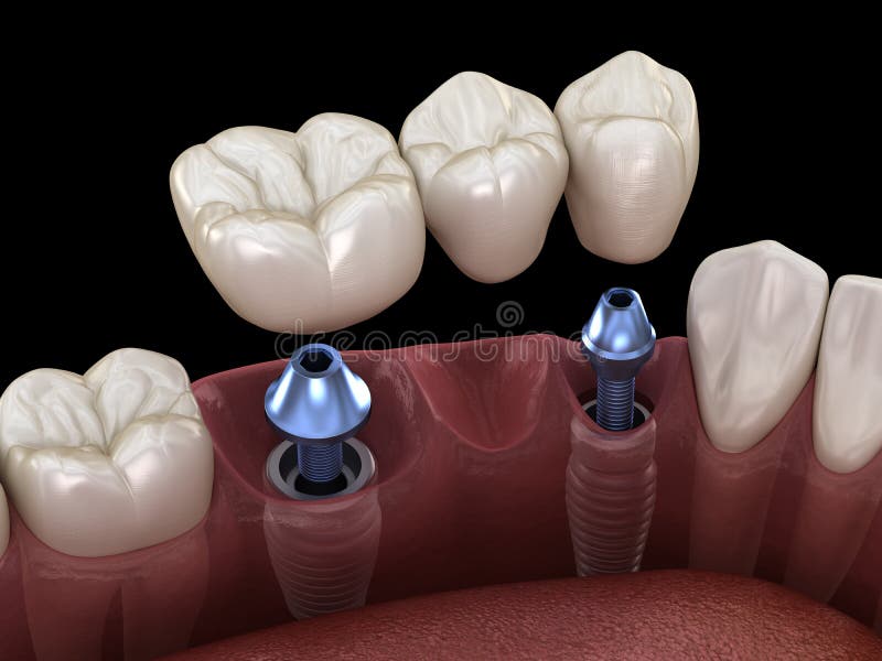 Dental Bridge of 3 Teeth Over Molar and Premolar. Medically Accurate 3D ...