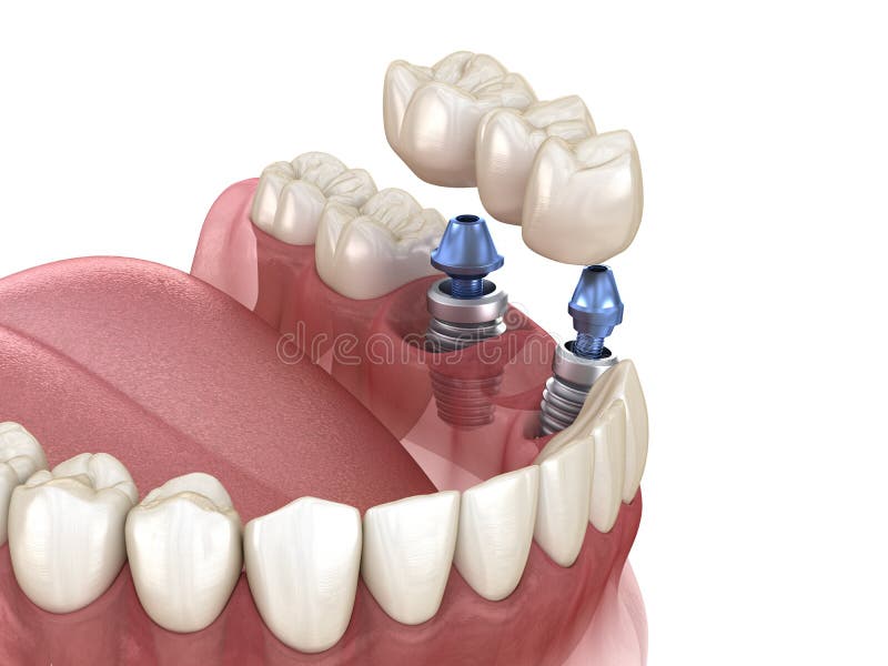 Dental Bridge Supported by Implants. Medically Accurate 3D Illustration ...