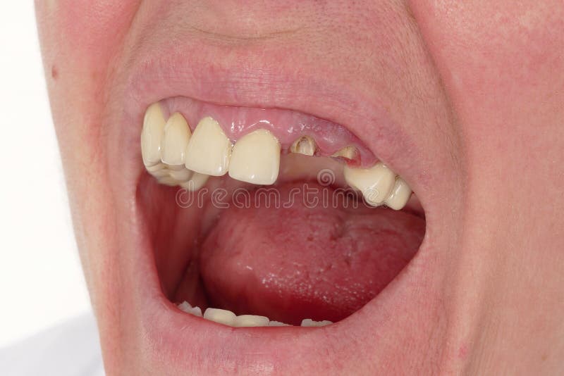 Dental, broken teeth stock image. Image of adult, ceramics - 52750707