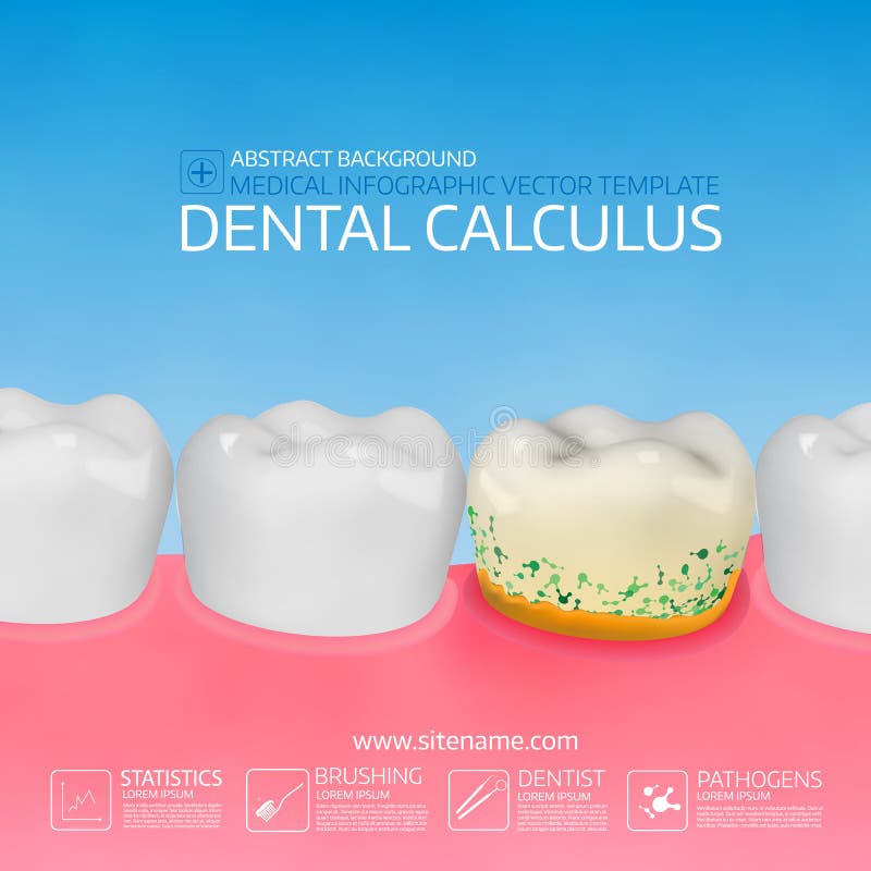 Dental Calculus with Bacteria. Colorful Vector Illustration. Stock ...