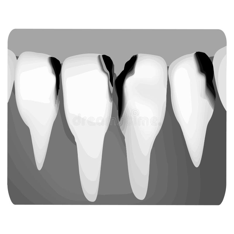 Dental Caries. X-ray of Tooth Decay. Caries Infographics. Vector ...