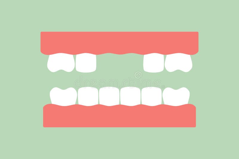 Missing Tooth, Space between Teeth in Mouth Stock Illustration ...