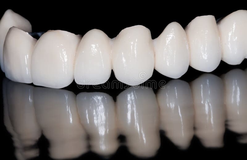 Dental bridge stock photo. Image of reflection, hygiene - 30240456