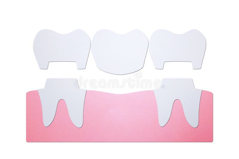 Dental bridge stock vector. Illustration of cartoon, mouth - 90199093