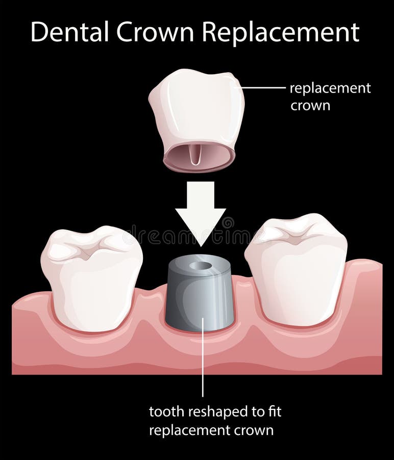 Dental Crown Installation Process Stock Illustration - Illustration of ...
