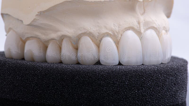 Dental Crowns. Close-up Ceramic Tooth Crown Stock Image - Image of care ...